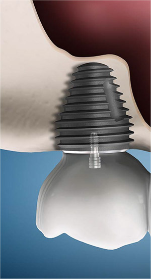 Post Extraction Molar Tooth Replacement | Southern Implants
