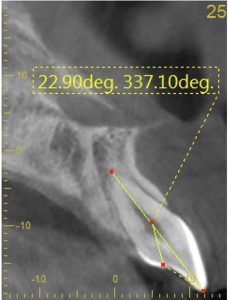Angulation of Tooth Root Axis Relative to Planned Prosthetic Screw Axis ...