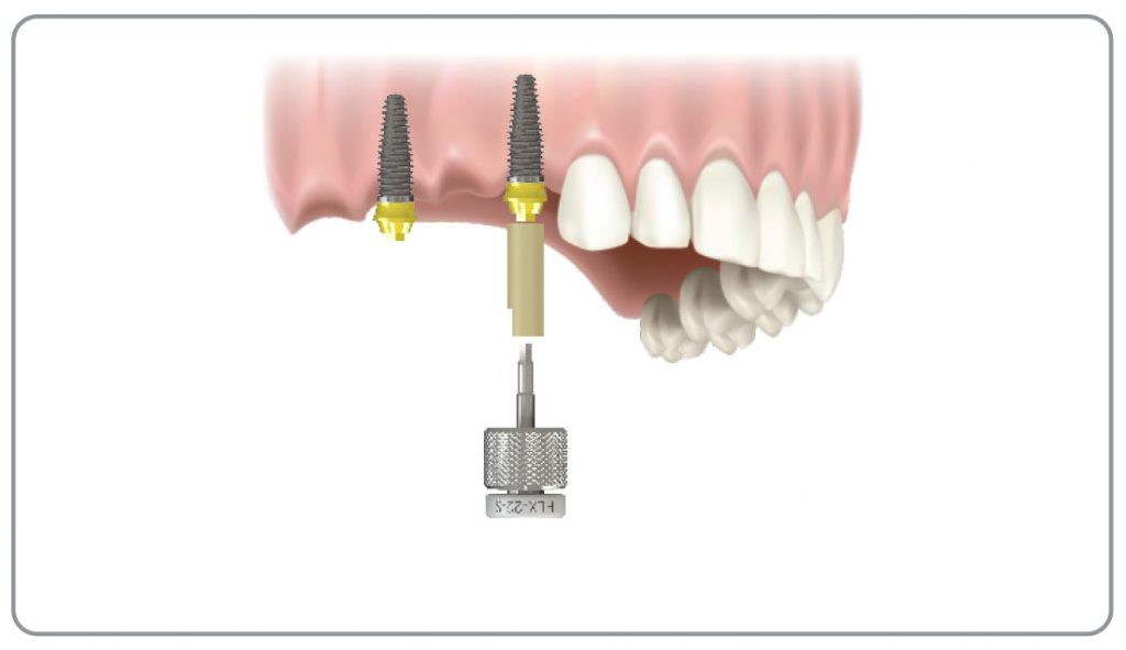 Scan Flag/Scan Body | Southern Implants