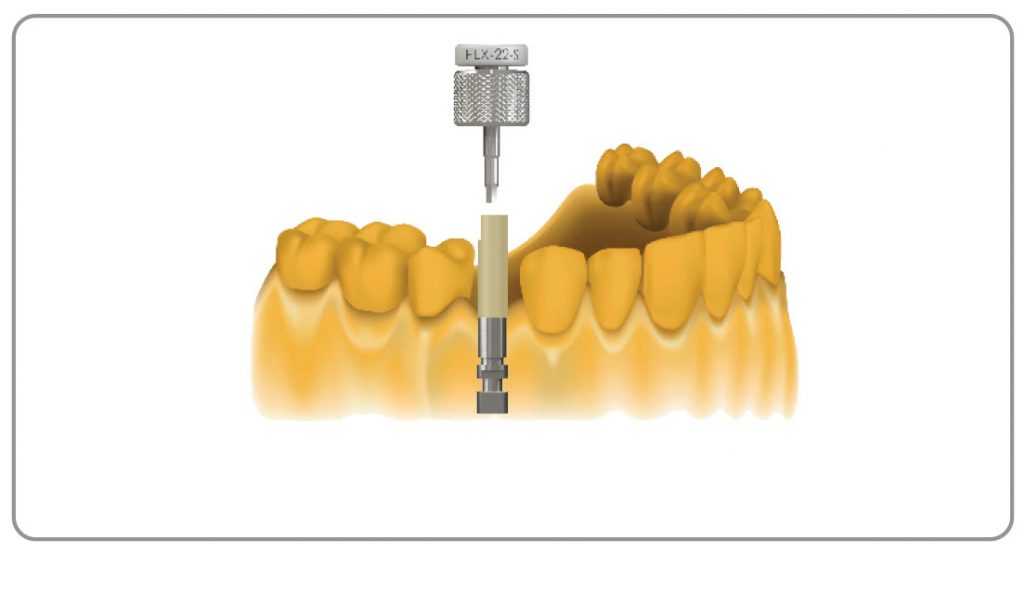 Scan Flag/Scan Body | Southern Implants