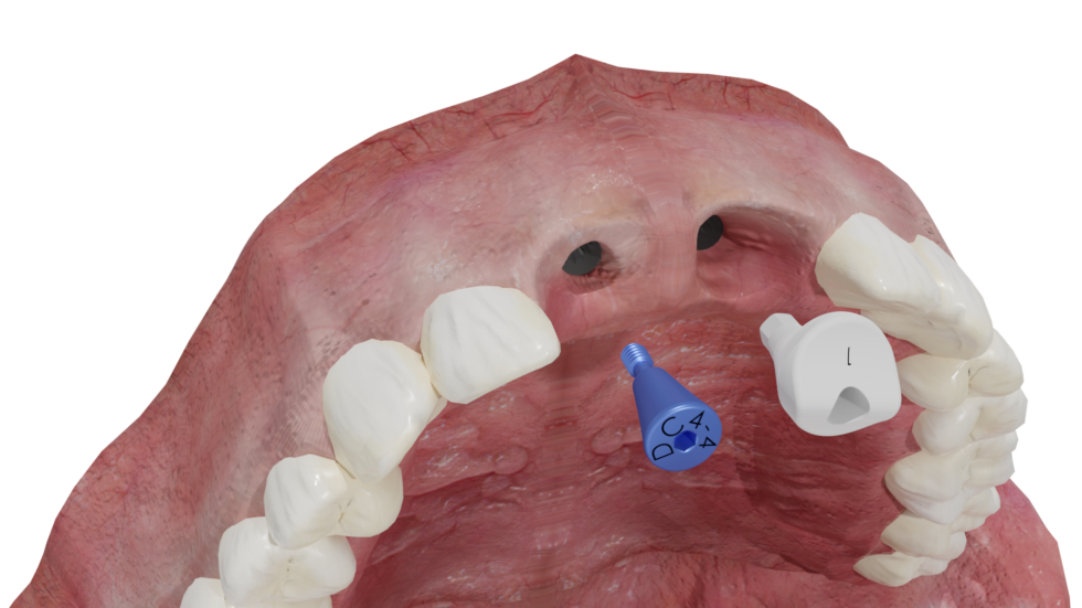 TOP Abutment | Southern Implants