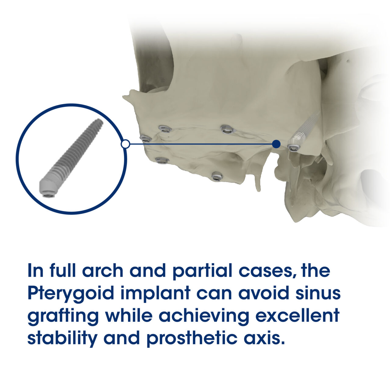 IBR Pterygoid Implants | Southern Implants