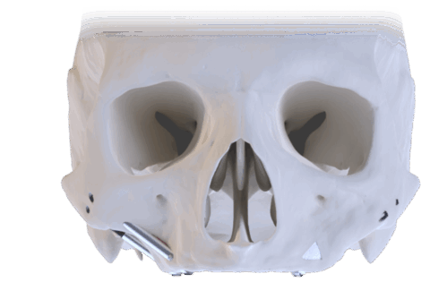 Zygomatic Implants | Southern Implants