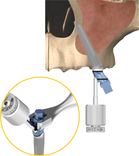 Nazalus Implants | Southern Implants