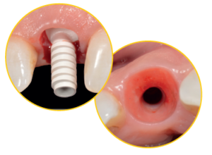 TOP Abutment | Southern Implants