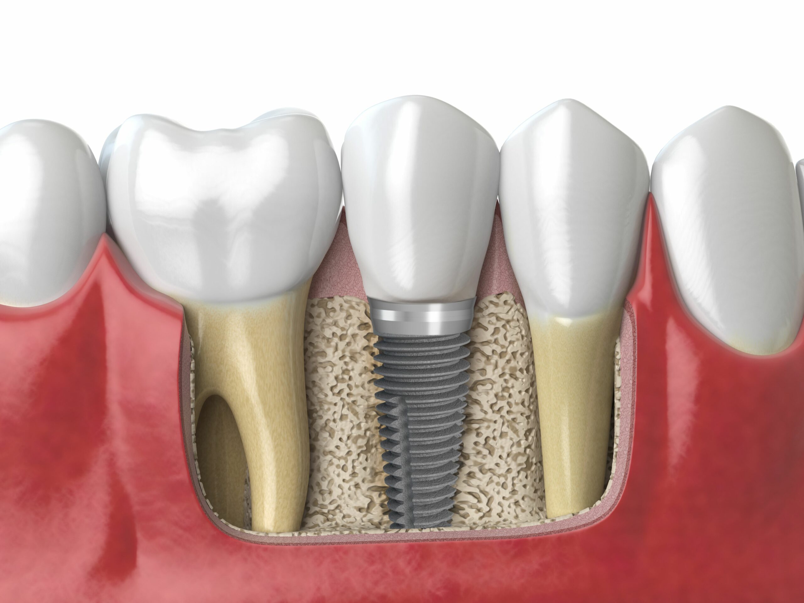 Patient Q and A | Southern Implants