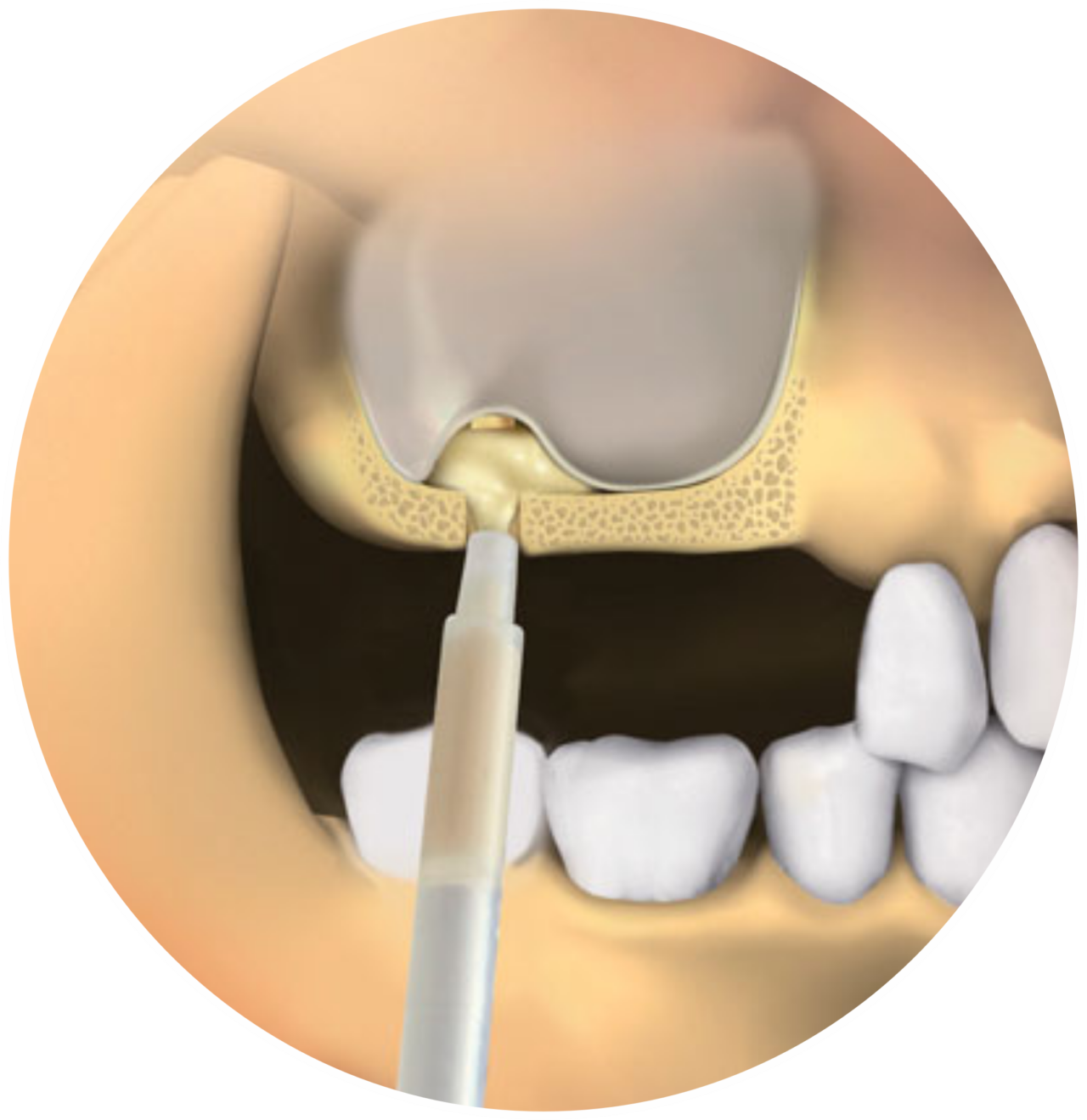 Patient: Sinus lifts/bone grafts | Southern Implants