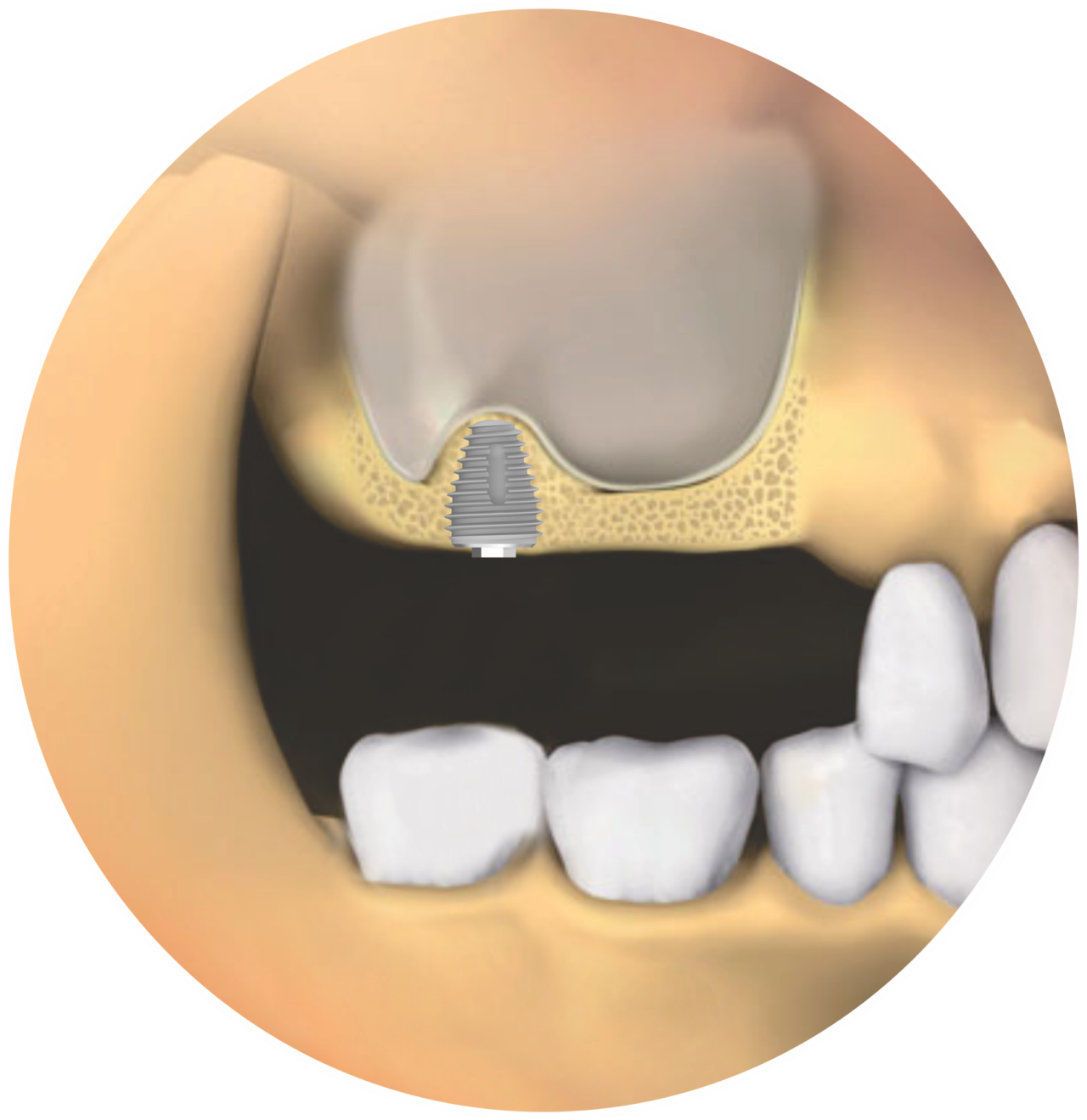Patient: Sinus lifts/bone grafts | Southern Implants