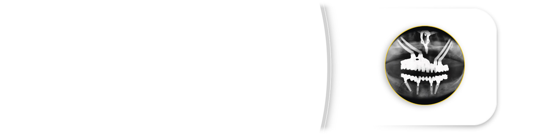 Southern Implants, Dental Implant Treatment Solutions, Innovative ...